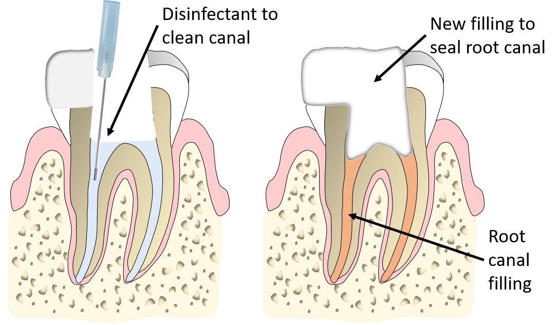 Root Canal Treatment – Dr James Chesterman