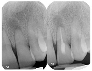 Endodontic cases – Dr James Chesterman