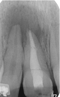 Endodontic cases – Dr James Chesterman