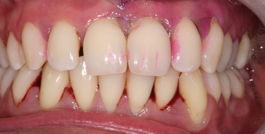 Periodontal cases – Dr James Chesterman