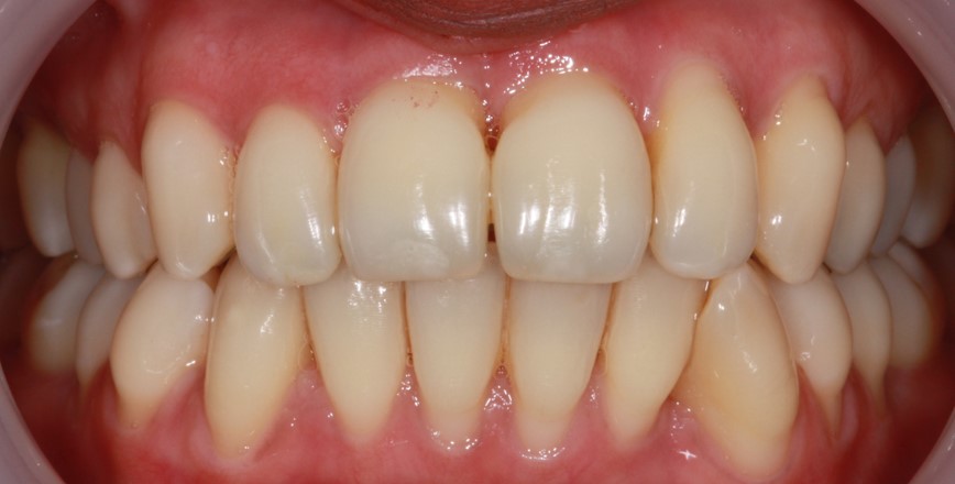 Periodontal cases – Dr James Chesterman