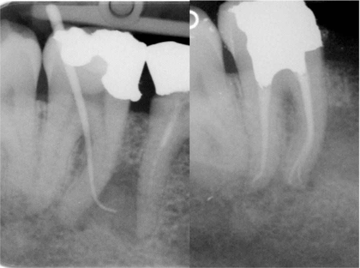 Endodontic cases – Dr James Chesterman