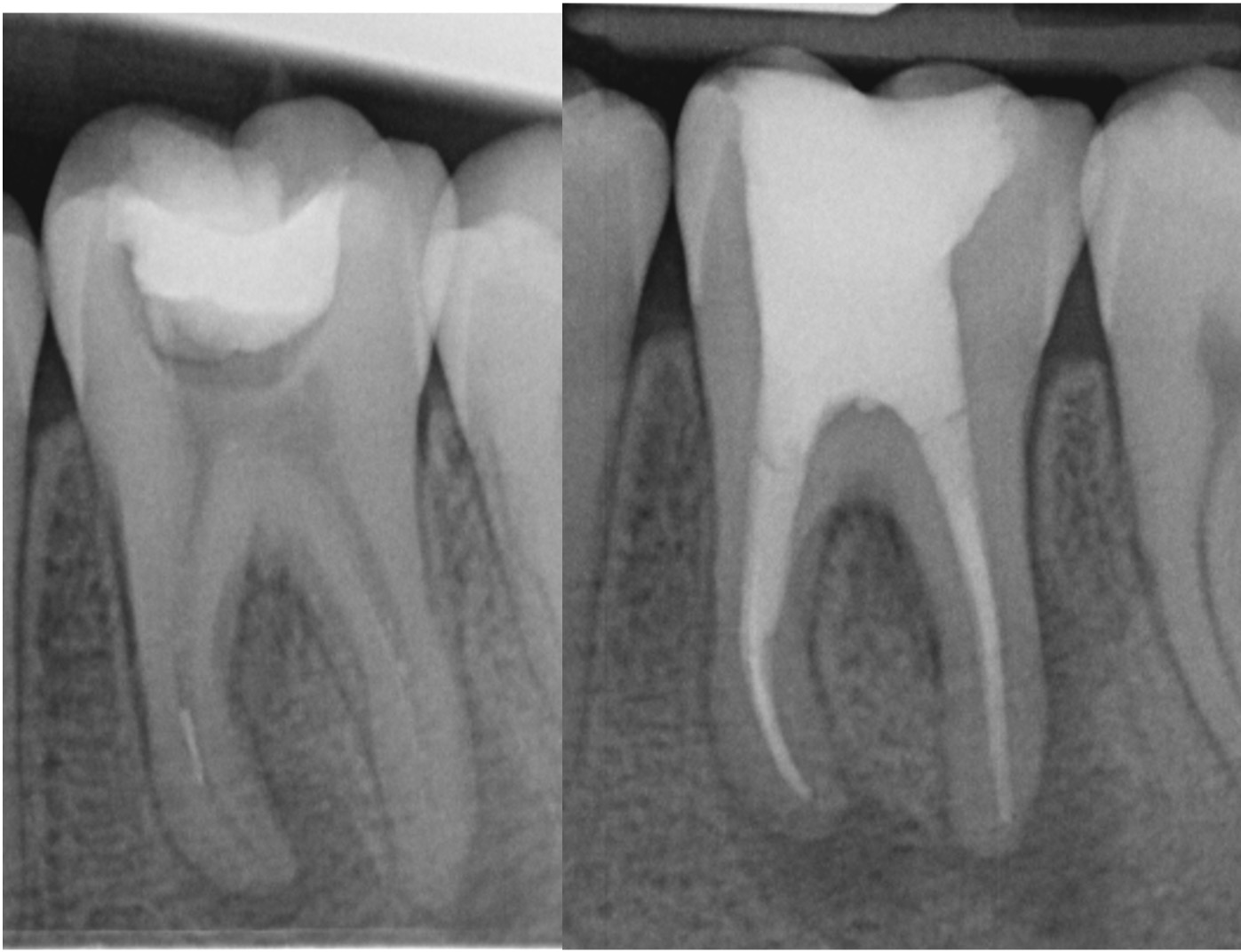 Endodontic cases – Dr James Chesterman