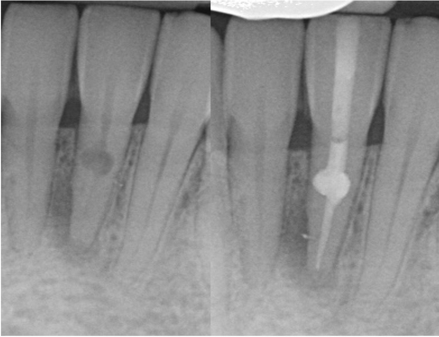 Endodontic cases – Dr James Chesterman