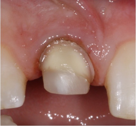 Endodontic cases – Dr James Chesterman