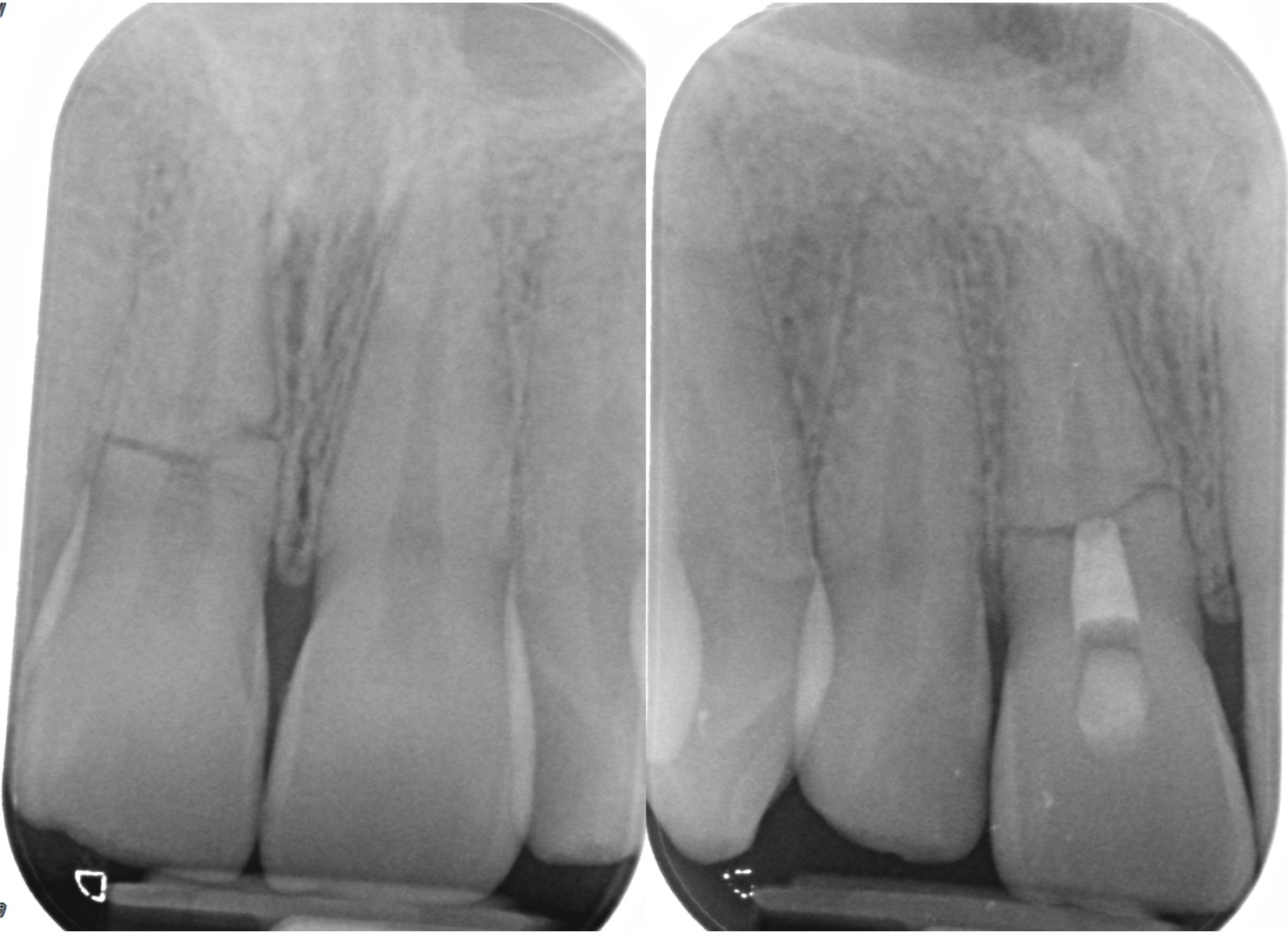 Endodontic cases – Dr James Chesterman