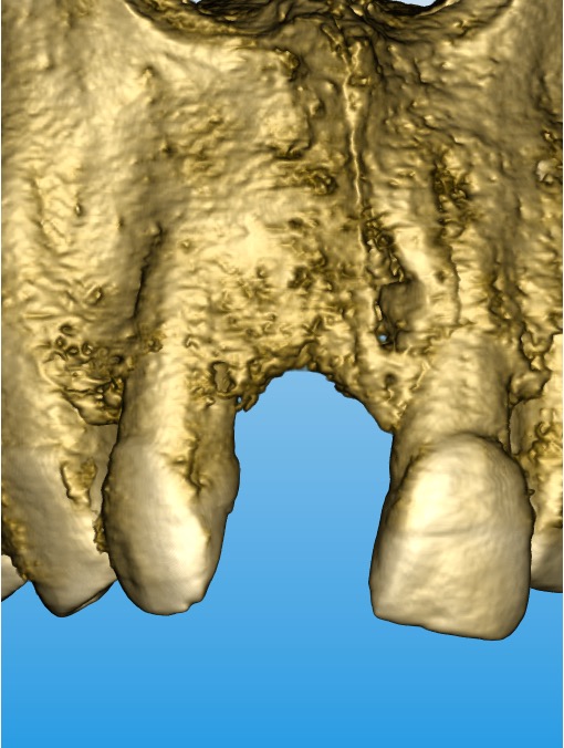 Dental Implants – Dr James Chesterman