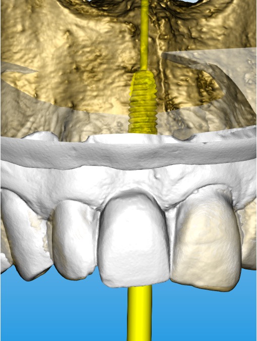 Dental Implants – Dr James Chesterman