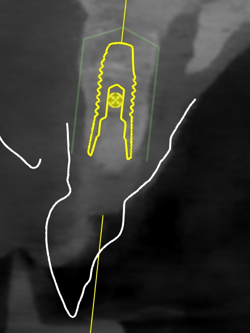 Dental Implants – Dr James Chesterman