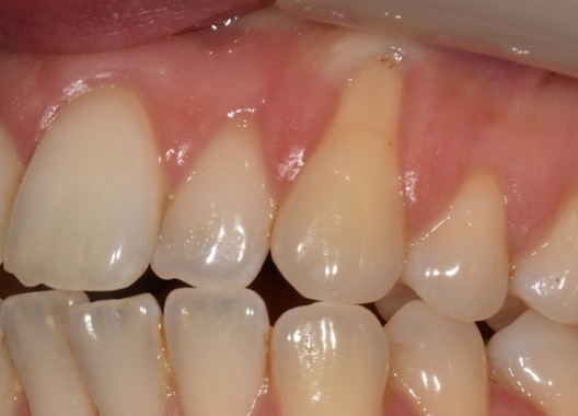 Periodontal cases – Dr James Chesterman
